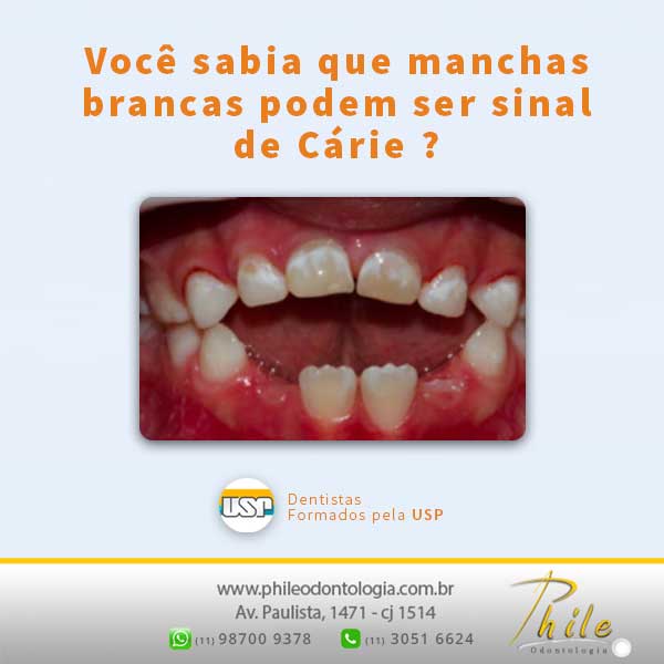 Você sabia que manchas brancas nos dentes podem ser sinal de Cárie Você sabia que manchas brancas nos dentes podem ser sinal de Cárie